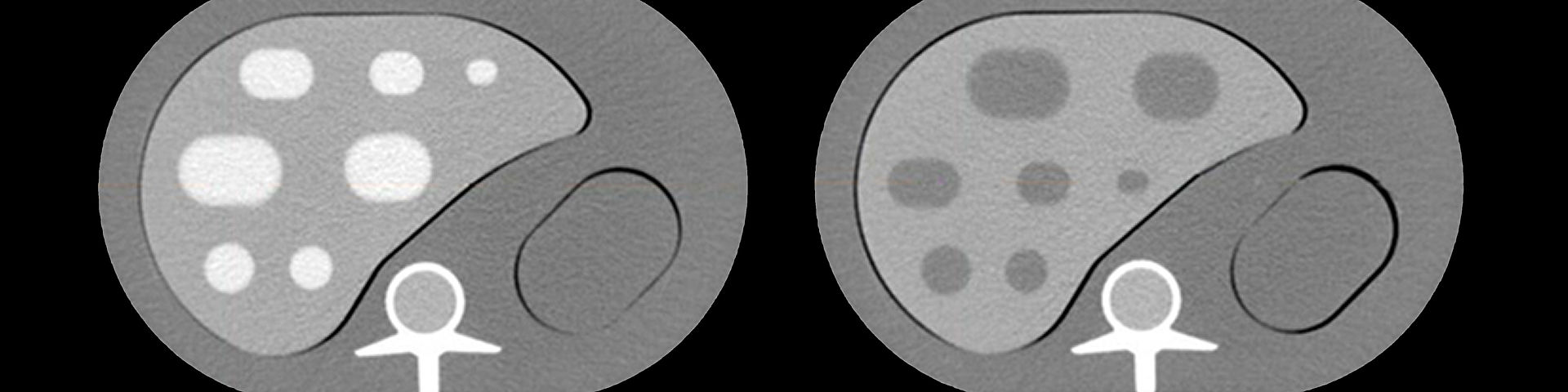 Liver Nodule Phantom | A PTW Company