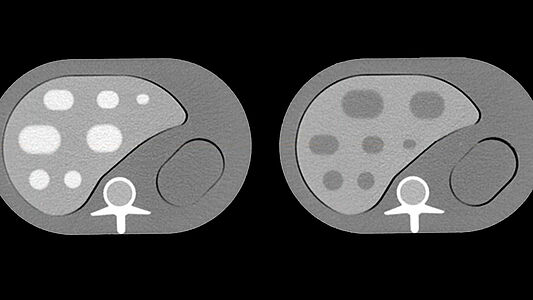 Liver Nodule Phantom | A PTW Company